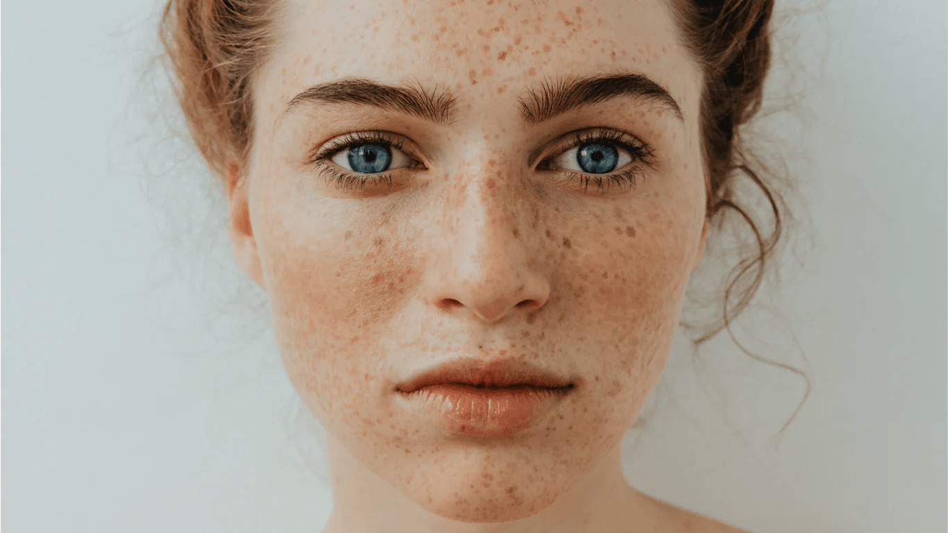 Melasma Frustration? Discover Effective Solutions Here
