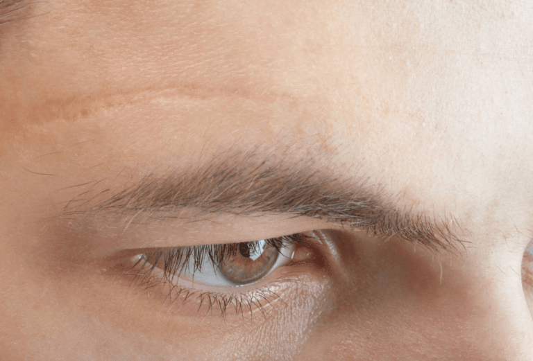 Why do I scar so easily? - Dr Ebru Okyay - Dermatologist in Antalya